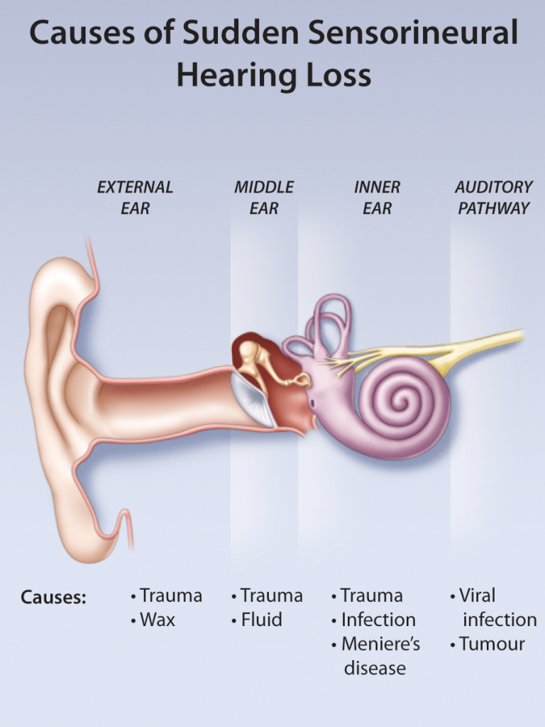 Hyperbaric Oxygen Therapy (HBOT) for Sudden Sensorineural Hearing Loss ...