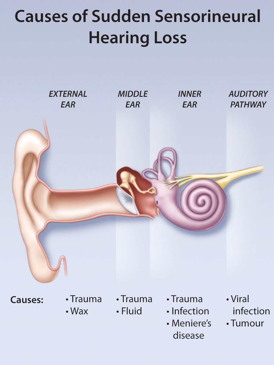 Hyperbaric Oxygen Therapy HBOT For Sudden Sensorineural Hearing Loss