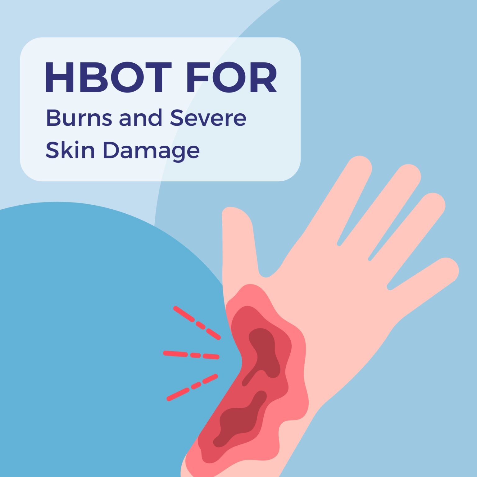 Promoting Healing: The Benefits of Hyperbaric Oxygen Therapy for Burns ...